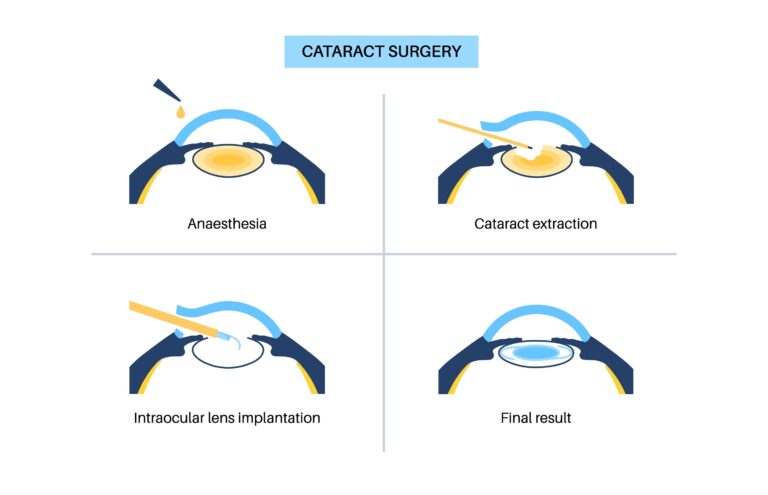 How Laser Technology Can Improve Your Cataract Surgery in 2026 - South ...