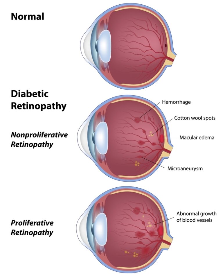 How Do Eye Doctors Treat Diabetic Retinopathy? - South Texas Eye Institute